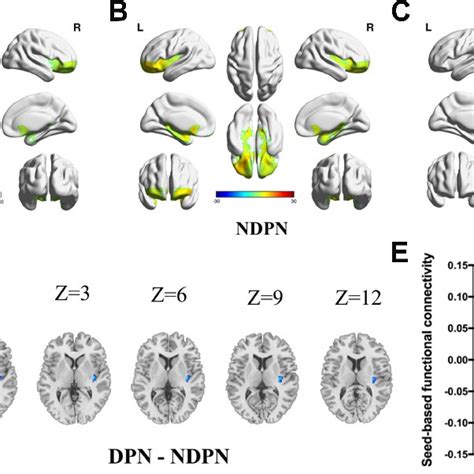 Comparison Of Seed Based Functional Connectivity In Dpn And Ndpn The
