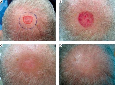 Basal Cell Carcinoma Scalp Surgery