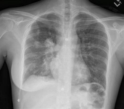 pleural effusion undergraduate diagnostic imaging fundamentals