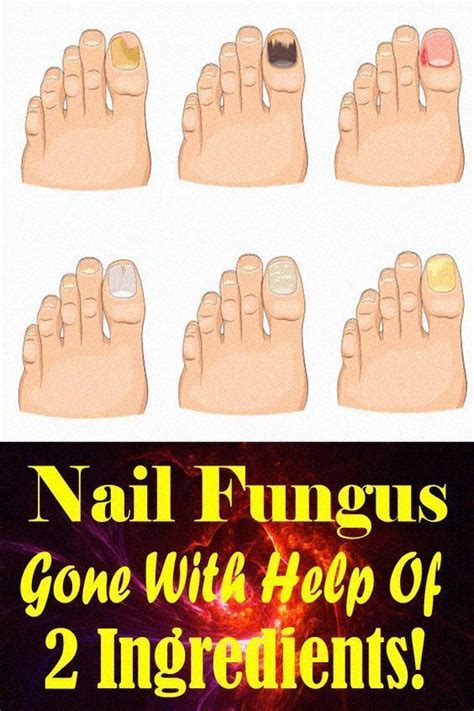 How To Get Rid Of Toenail Fungus Fast And Naturally Artofit