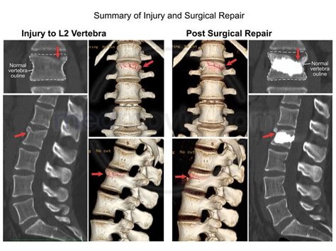 L2 Vertebral Body Compression Fracture And Surgical Repair