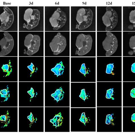 Ivim Dwi And Pathological Parameters In Different Time Points From