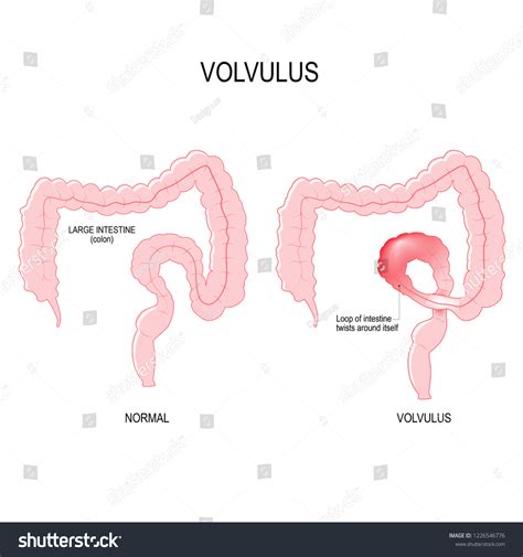 Sigmoid Colon Volvulus