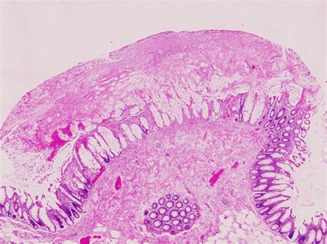 Pathology Outlines Antibiotic Associated Colitis