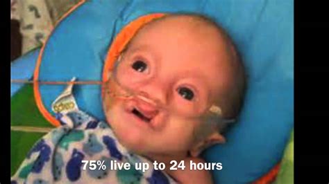 Edwards Syndrome Psa Youtube
