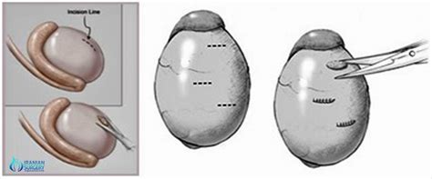 Testicular Biopsy In Iran As Infertility Treatment Iranian Surgery