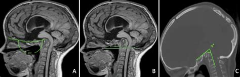 Obstructive Hydrocephalus Treated With Endoscopic Third Ventriculostomy