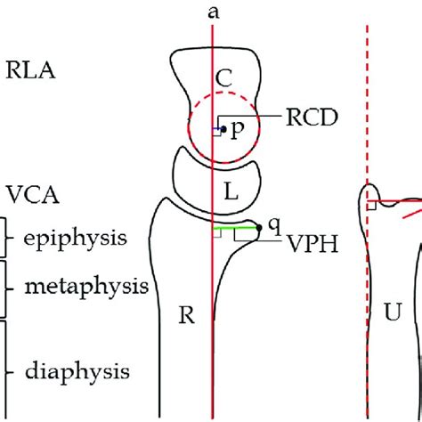 Volar Tilt Vt The Angle Between Lines B And C Radiolunate Angle