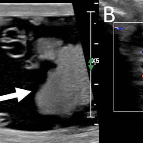 A Axial Grayscale Ultrasound Image Of The Scrotum Adjacent To The
