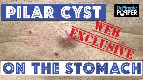 Web Exclusive Sneak Peek A Brazilian Born Bump Excised By Dr Pimple