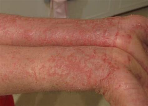 A Comparison Of Psoriasis Severity In Pediatric Patients Treated With