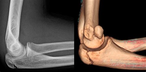 Monteggia Fracture Pediatric Pediatrics Orthobullets