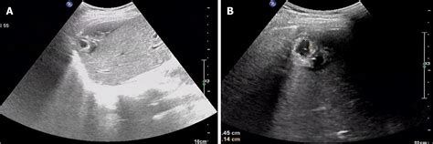 Ectopic Pregnancy Implanted Under The Diaphragm A Rare Case Report
