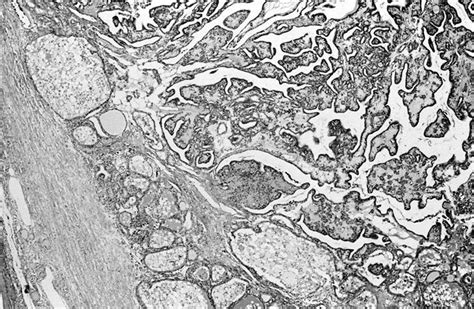 Pathology Outlines Follicular Adenoma