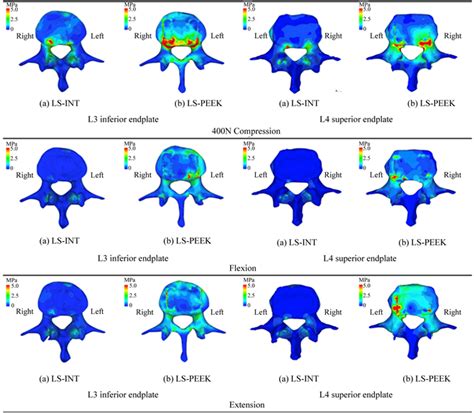 Use Of Nonlinear Finite Element Analysis Of Bone Density To Investigate