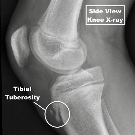 Osgood Schlatters Disease Knee