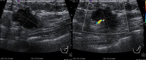 Mammogram Focal Asymmetry Radiology Cases