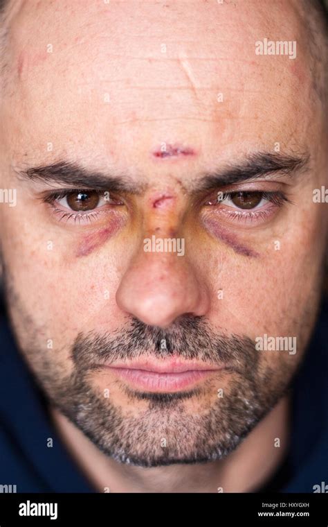 Cara De Un Hombre Herido Con Heridas Y Ojos Negros Soft Focus