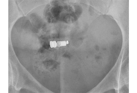 foreign bodies in the gastrointestinal and genitourinary tracts