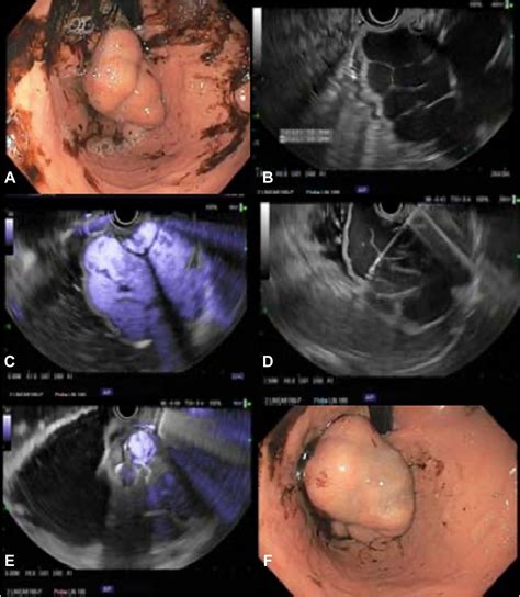 Eus Guided Coil Injection Therapy In The Management Of Gastric Varices