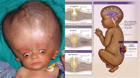 Understanding Spina Bifida And Hydrocephalus Bethany Tv