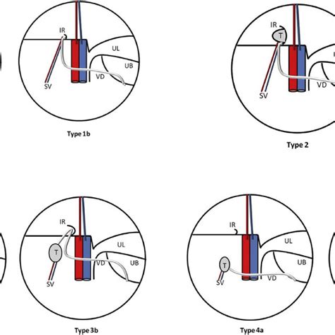 Updated Ain Shams Classification Of Impalpable Undescended Testes Ir