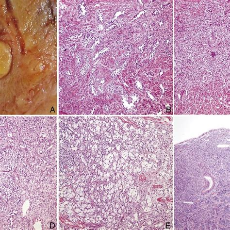 Pdf Uterine Tumors Resembling Ovarian Sex Cord Stromal Tumors