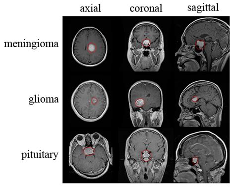 Applied Sciences Free Full Text Classification Of Brain Tumors From