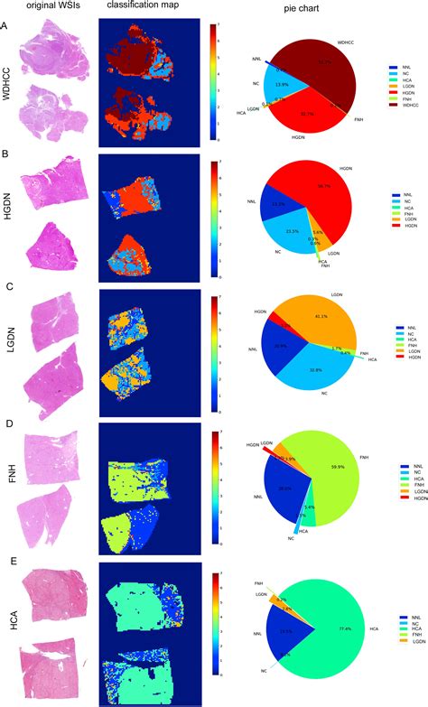 Deep Learning Based Classification Of Hepatocellular Nodular Lesions On
