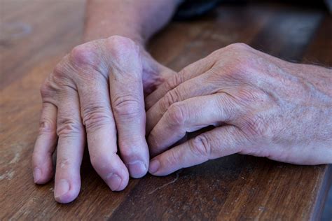 Psoriatic Arthritis Types Symptoms Causes And Treatments Apollo