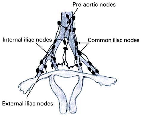 assessment of sentinel lymph node in cervical cancer