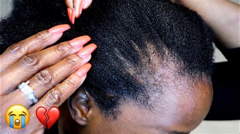My Hair Fell Out In Clumps Natural Hair Recovery Routine Youtube