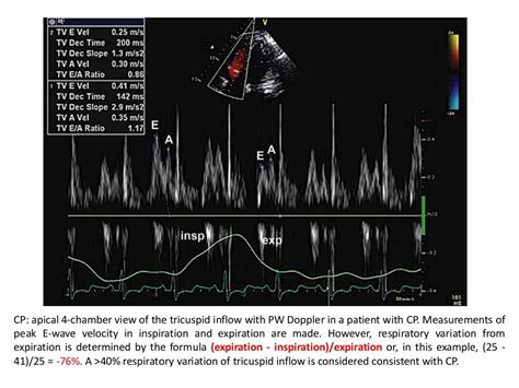 Echo Differentiation Of Restrictive Cardiomyopathy And Constrictive P…