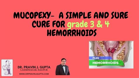 Ligation And Mucopexy For Prolapsing Hemorrhoids Simple And Sure Cure