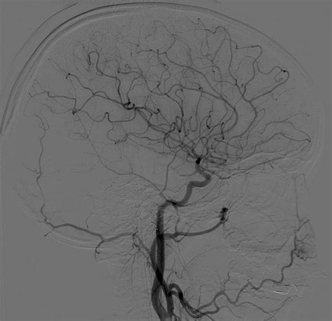 Digital Subtraction Angiography Showing Preoperative Embolization Of