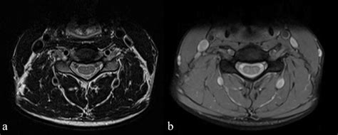 T2 Weighted Images On Axial Plane In The Same Patient A T2 Tse