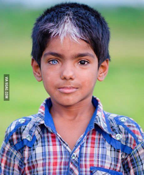 White Forelock Of Hair Waardenburg Syndrome Wikipedia