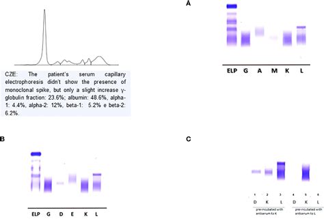 frontiers case report a case of igd lambda lambda multiple myeloma