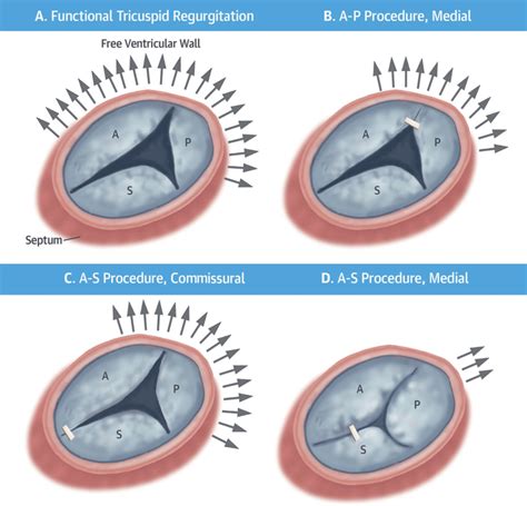 A In Functional Tricuspid Regurgitation Ftr The Anterior A And