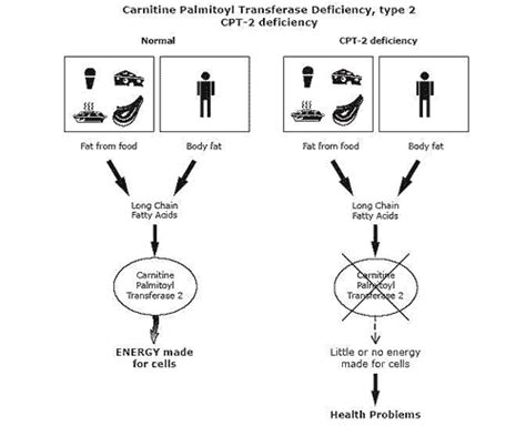 Cpt 2 Carnitine Palmitoyl Transferase Deficiency Type 2