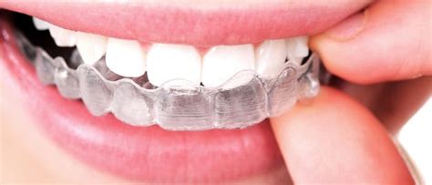 How Long Does It Take To Get Used To Invisalign® Clear Aligners
