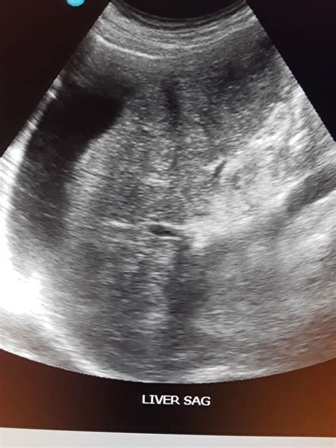 Liver Cirrhosis Ultrasound