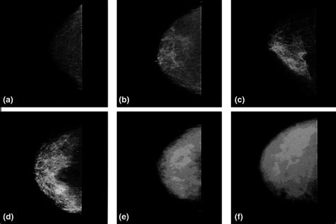 Examples Of Mammographic Density A 0 B Download Scientific Diagram