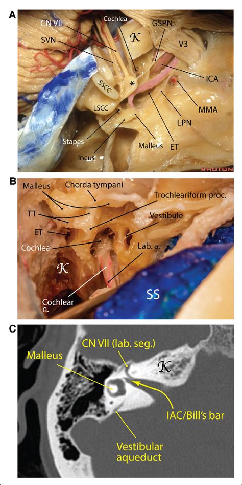 Carotid Canal Temporal Bone