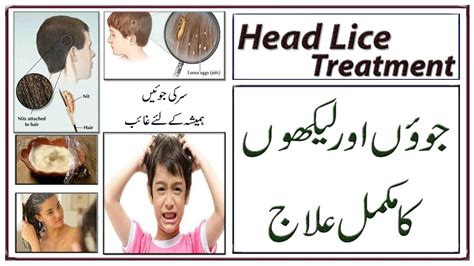 Head Lice Treatment 3 Easy And Fast Ways Ll سر کی جوؤں اور لیکھوں کا