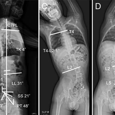 A And B Preoperative Anteroposterior A And Lateral B Standing