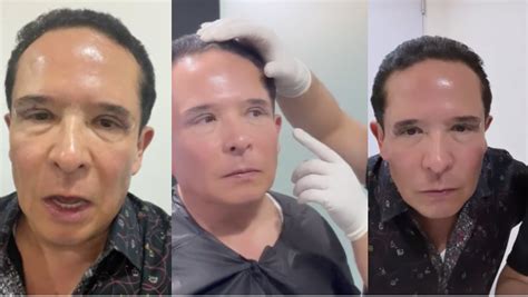 Gustavo Adolfo Infante Se Sometió A Una Cirugía Estética Así Luce Tras