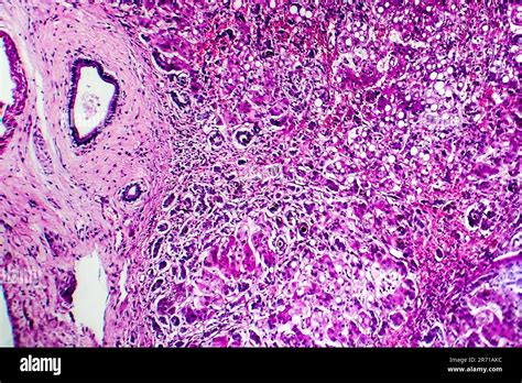 Histopathology Of Biliary Liver Cirrhosis Light Micrograph Photo