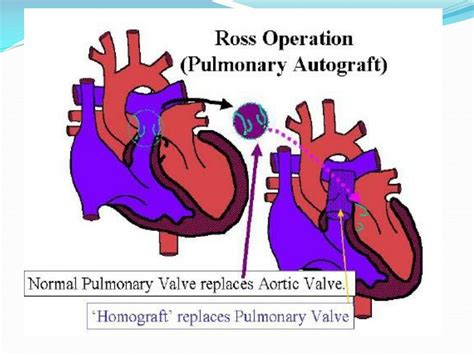 Ppt Valvular Heart Disease Cardiomyopathy And Aneursyms Powerpoint