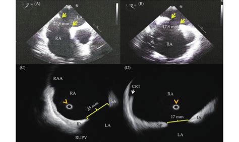 Baseline Two Dimensional Transoeophageal Echocardiogram At 45 Degree